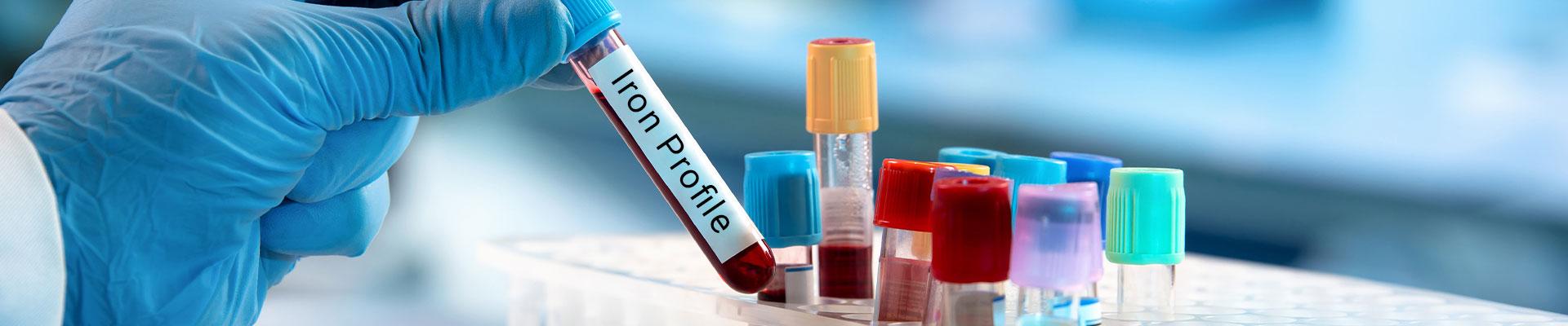 What is Iron Profile test? | HOD