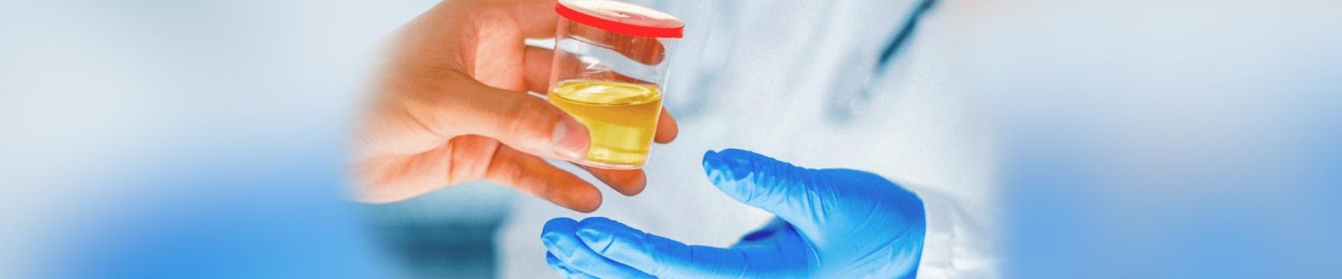 Urinalysis - Purpose, Testing Phases, Reasons And Results | HOD